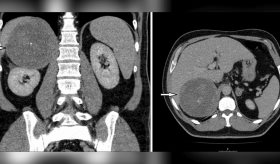 ¿Qué son el fenómeno del alba y el efecto Somogyi en diabetes y por qué ...