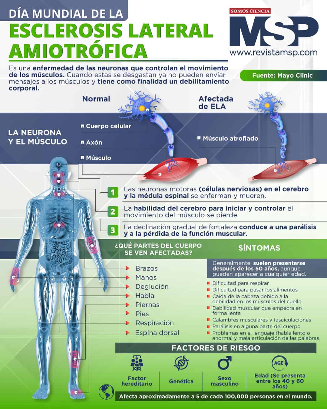 Esclerosis Lateral Amiotrófica
