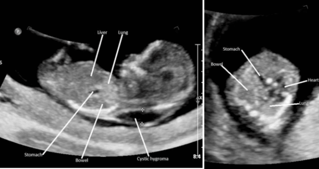Neonato con higroma quístico y corazón desplazado es diagnosticado con ...