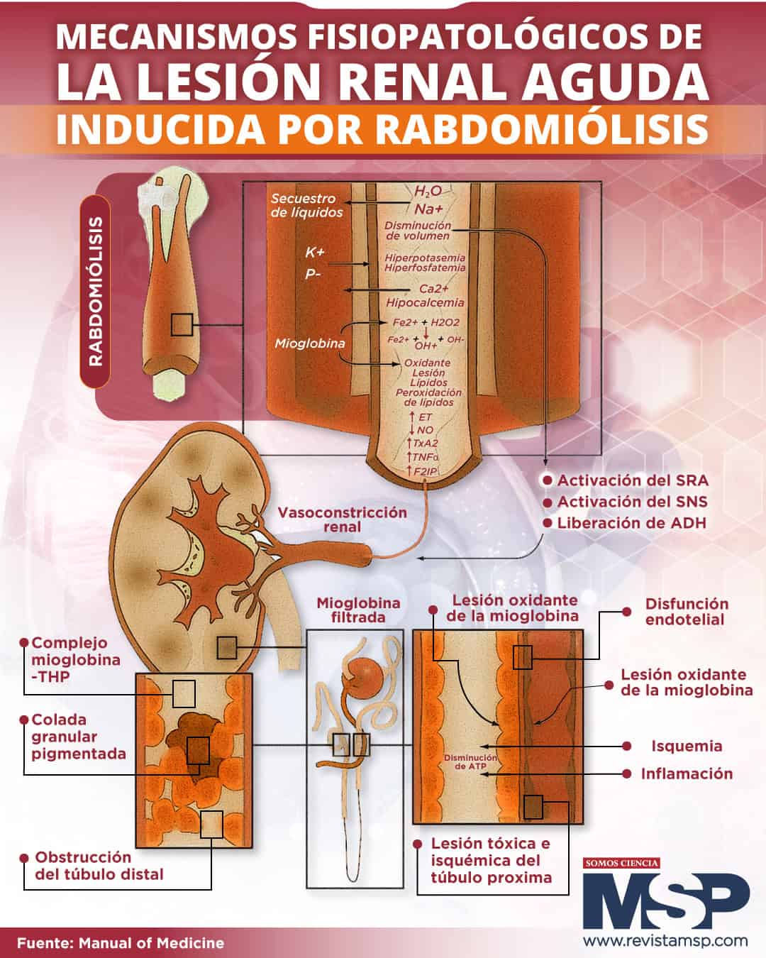 Mecanismos fisiopatológicos de la lesión renal aguda inducida por ...