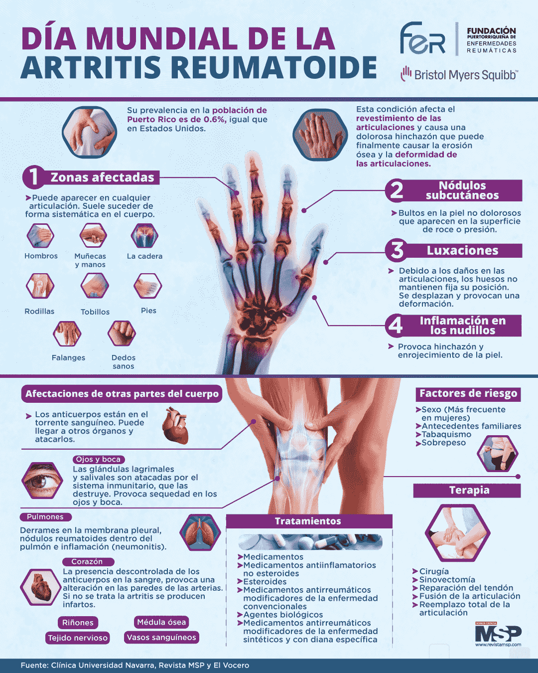 Artritis reumatoide