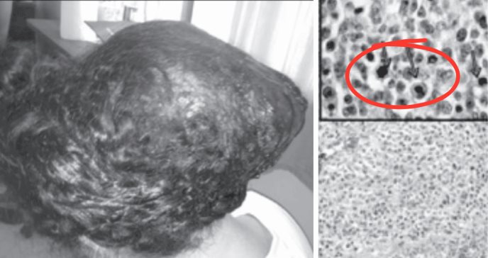 Sarcoma de Ewing en una mujer joven con masa en la región parieto ...